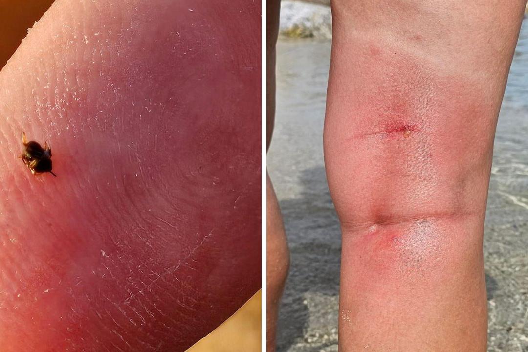 Punture e ponfi rossi, è allarme tra i bagnanti di Bivona e del ...