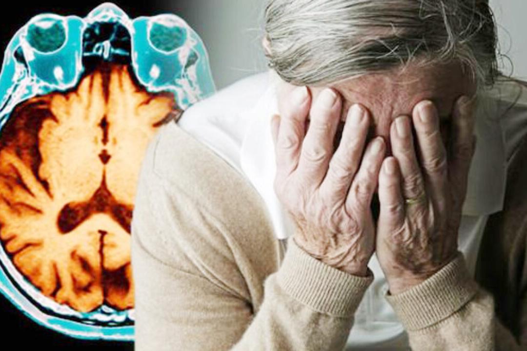 Alzheimer, brevettata la molecola smart Sulfavant A: nello studio anche ...